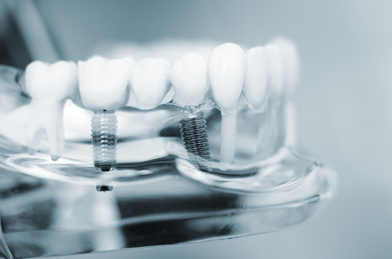 Titanium in Medical Technology | Electronic Competence